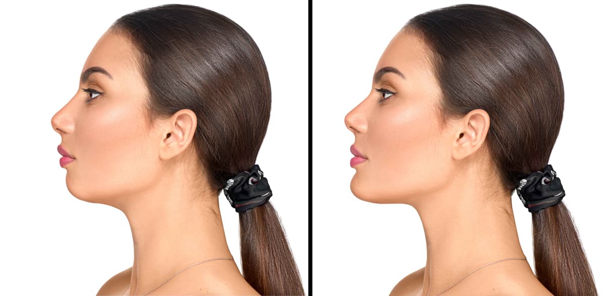 Chin Implant in New Jersey - Find Your Surgeon