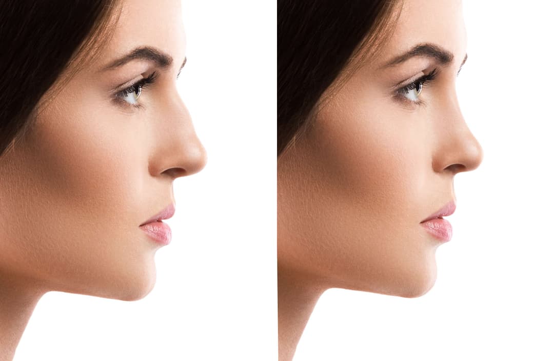 Rhinoplasty in LA - Find Your Surgeon