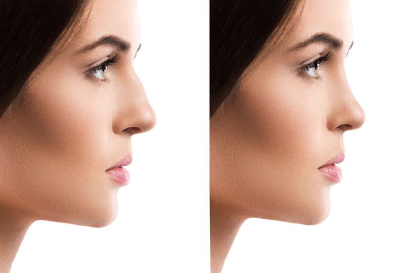 Rhinoplasty (Nose Job) in Atlanta - Find Your Surgeon
